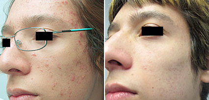 Bye-Acne Laser - La Chele Medical Aesthetics, LLC