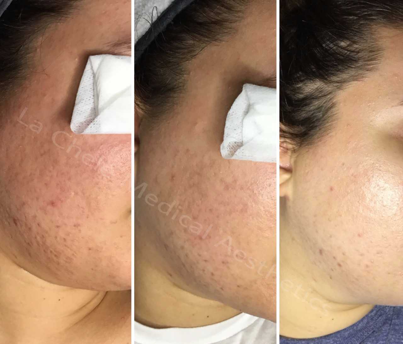 Bye-Acne Laser - La Chele Medical Aesthetics, LLC