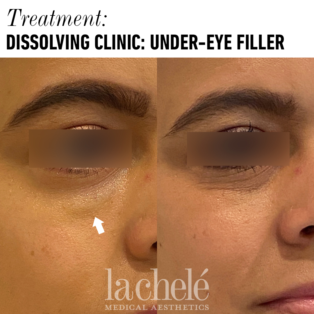 Dissolving Clinic - La Chelé Medical Aesthetics