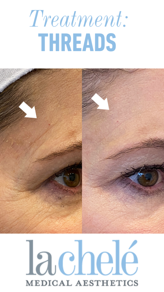 PDO Threads | Bucks County, PA - La Chelé Medical Aesthetics