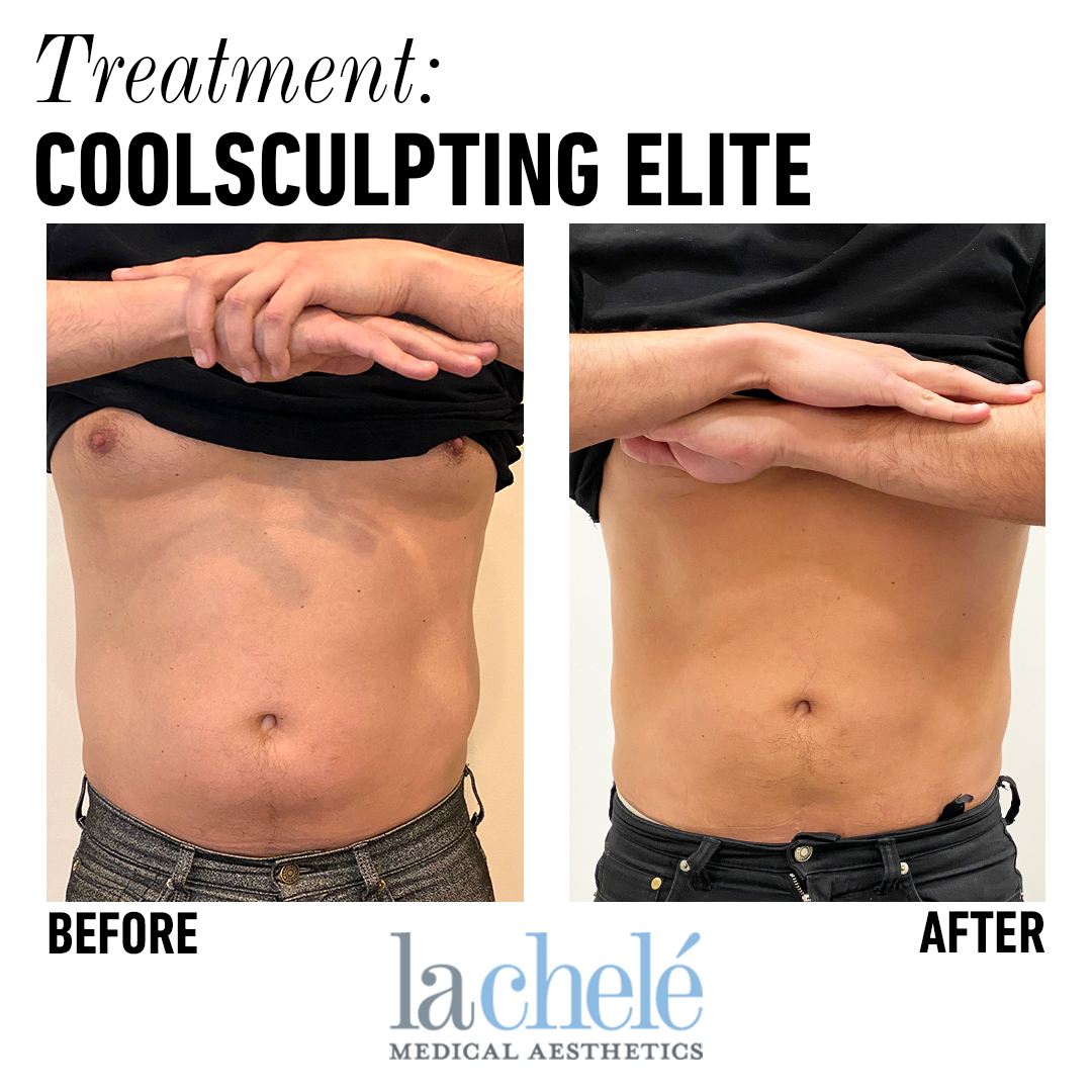 What is CoolSculpting Elite? - Bucks County, PA | La Chelé