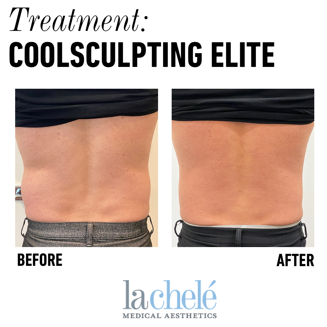 Coolsculpting Elite New Hope PA, Newtown - La Chele Medical